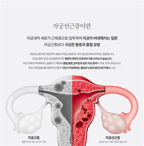 고난이도 하이푸 자궁근종 자궁선근증 여성종양치료 서울하이케어의원