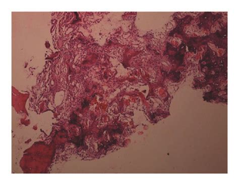 Photomicrograph Of The Lesion Revealing Abundant Osteoid Formation