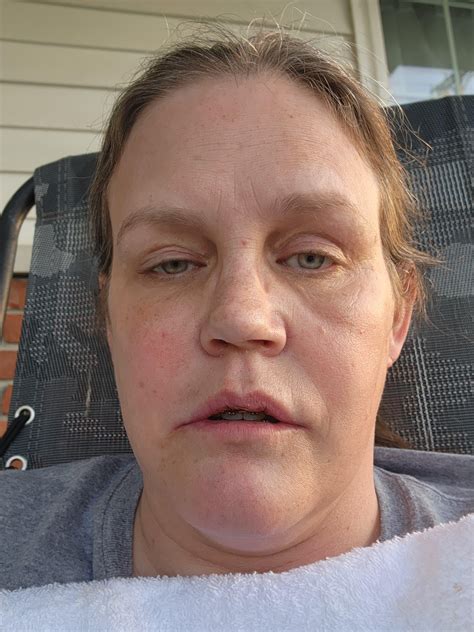 Overbite Jaw Surgery And Tmj Rjawsurgery