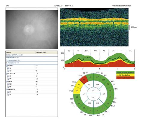 Oct Measurement Values And Image Of A Patient From The Patient Group