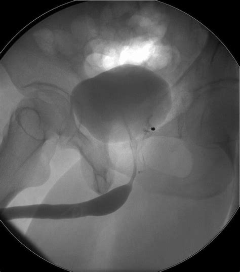 Retrograde Urethrogram Shows Opacification Of The Urethra And Bladder