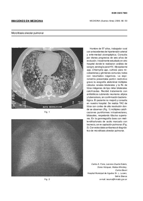 Pdf Microlitiasis Alveolar Pulmonar Leonora Duarte Sotelo