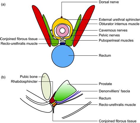 The Advance® Male Sling Anatomic Features In Relation To Mode Of