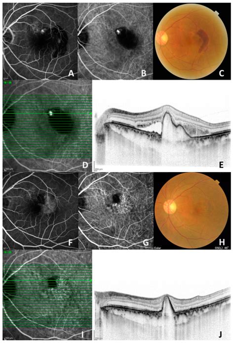 A Representative Case 76 Year Old Man Treated With A 3 Monthly