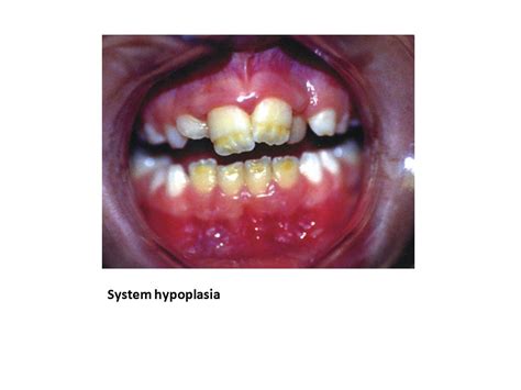 Turners Hypoplasia