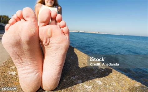 그녀의 드라이 피트 발바닥을 보여주는 해변에서 휴식 하는 여자 건강관리와 의술에 대한 스톡 사진 및 기타 이미지 건강관리와 의술 건조한 금이 간 Istock