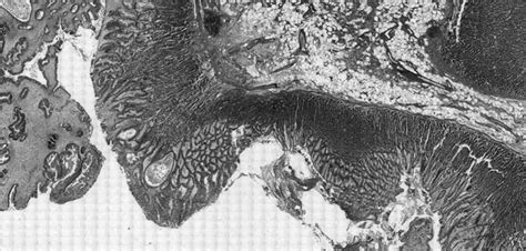 The Gastric Wall With Multiple Gastric Polyps With Different Download Scientific Diagram