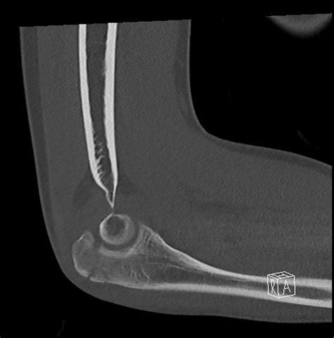 Olecranon Fracture Classification