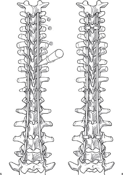 Transpedicular Decompression Neupsy Key