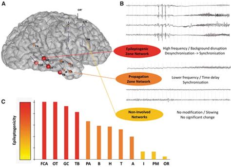 Interictal Functional Connectivity In Focal Refractory Epilepsies