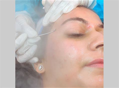 Cutis Comedone Extraction