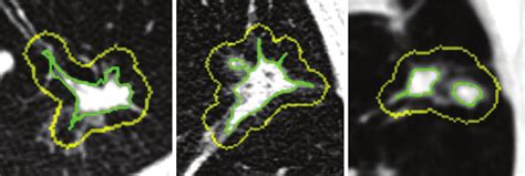 ct images show the segmentation of two three dimensional regions for