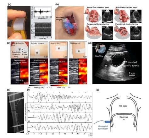 Medical Mems Emerging Wearable Ultrasound Technologies This Article Provides An Overview About