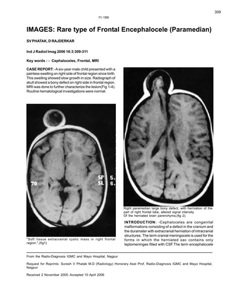 Pdf Images Rare Type Of Frontal Encephalocele Paramedian