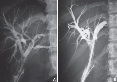 A Fistulogram Showing A Bismuth Type Iii Stricture B Postoperative Download Scientific Diagram