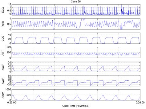 Case 26 Waveform Plots 60 Second Plots