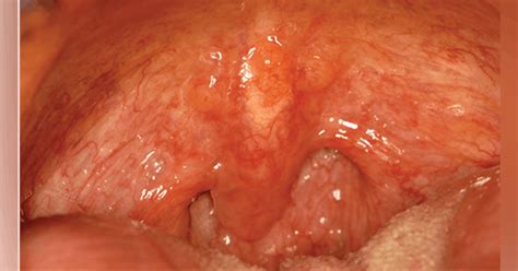 Reactive Lymphoid Hyperplasia Focal Lymphoid Hyperplasia Registered Dental Hygienists