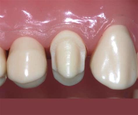 Indirect Restorations Metal Ceramic Pfm Crown Prep Upper 1st Premolar