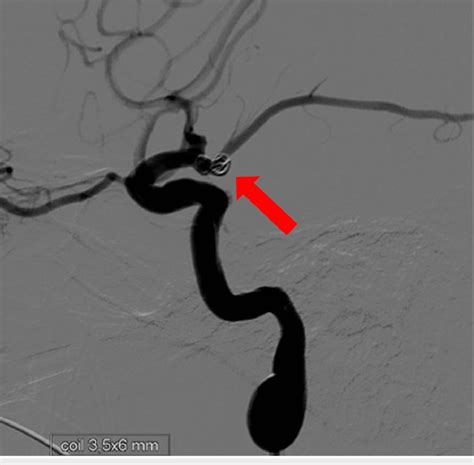 Cerebral Angiography Coil Target With Partial Occlusion Of The
