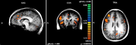 Display Of Activation Of The Anterior Cingulate Gyrus During The