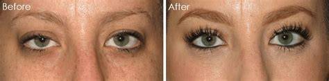 Eyelid Surgery Los Angeles Eyesthetica Eyelid Lift