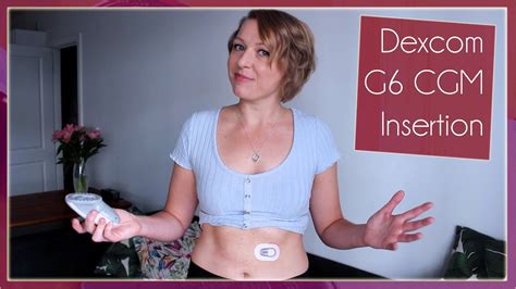 Dexcom G Sensor Insertion YouTube