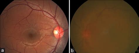 Artificial Intelligence In Cataract Whats New Global Journal Of Cataract Surgery And
