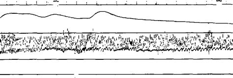 Figure 1 From Eeg Alpha Rhythm And Eyelid Flutter Semantic Scholar