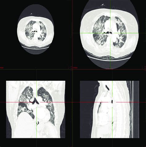 Bilateral Diffuse Zones Of Consolidation Pulmonary X Ray Showed Massive Download Scientific
