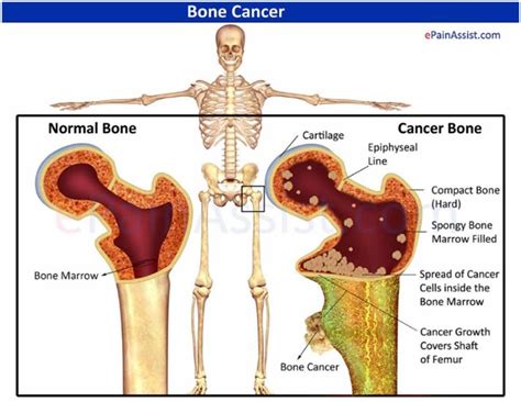 Bone Cancer Diagram