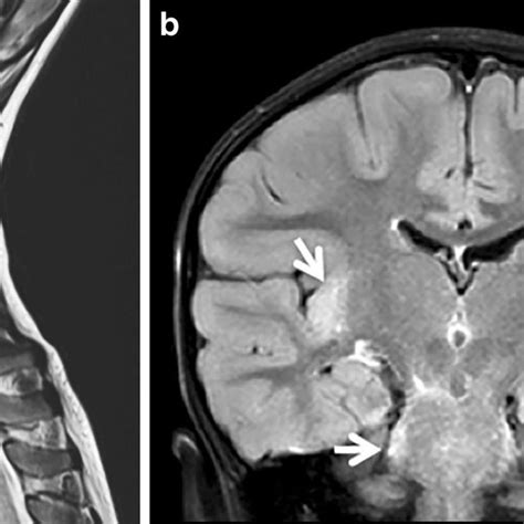 Multiple Sclerosis Ms In A 15 Year Old Girl With Tingling And