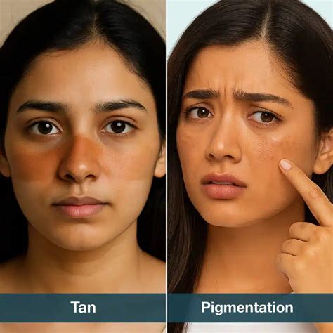 Best Pigmentation Treatments Recommended By Dermatologists