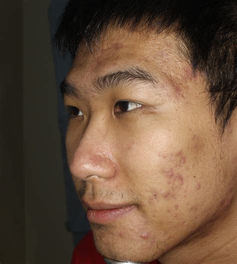 Acne Skin Object Detection Dataset By Phamphong