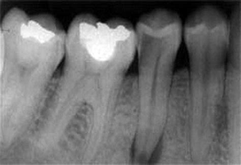real time dental caries detection from x ray images intel devmesh