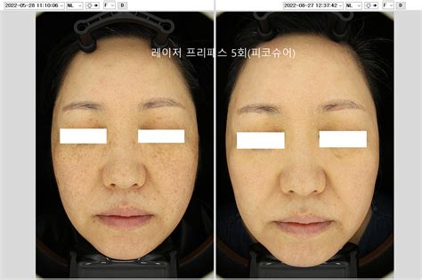 피코슈어레이저 시술 전 후 다시봄날의원 서창