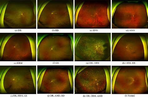 Figure 1 From Discriminative Region Multi Label Classification Of Ultra Widefield Fundus Images