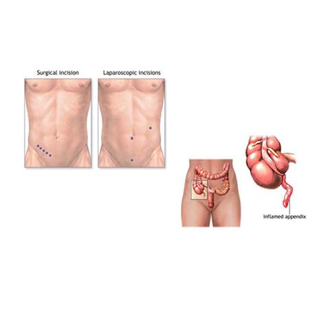 Loop Colostomy Reversal