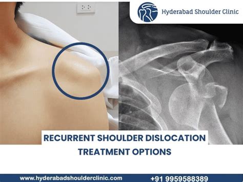 Recurrent Shoulder Dislocation Treatment Options In Hyderabad