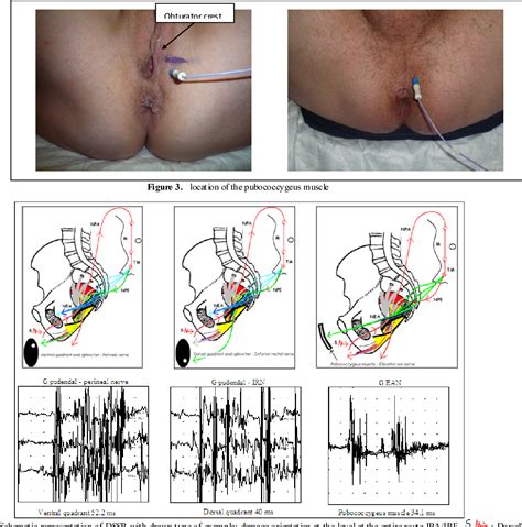 Figure 3 From Differential Staged Sacral Reflexes Methodology And Normal Values From 51 Healthy