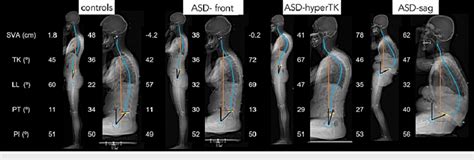 Sitting Postural Adaptations In The Four Groups Control Asdfront