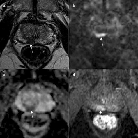 A 63 Year Old Man With Prostate Specific Antigen Level 817 Ngml The Download Scientific