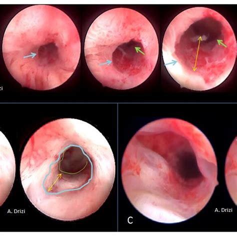 Uterine Isthmus At Hysteroscopy A Nulliparous Woman From The Cervix