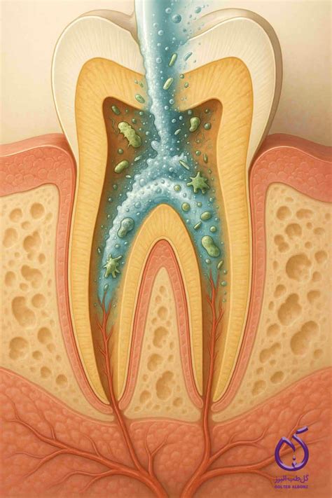 Root Canal Irrigation With Dental Irrigants A Review Of Edta And