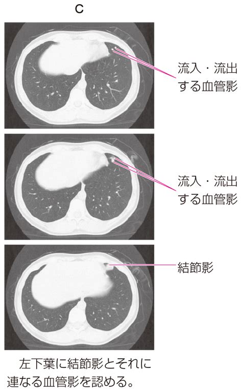 116d23 肺動静脈廔 国試 テコプラ