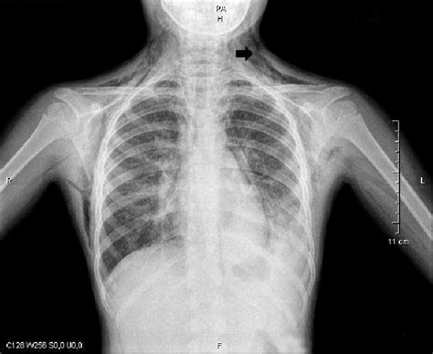 Chest X Ray Demonstrating Subcutaneous Emphysema Involving The Cervical Download Scientific