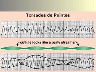Ventricular Flutter Vs Torsades