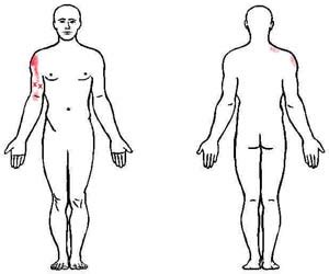Biceps Brachii Trigger Point