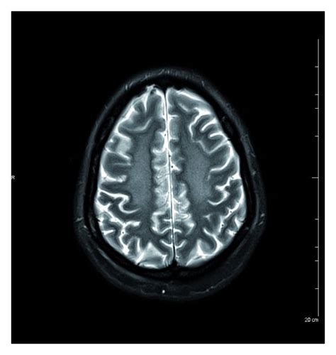 A Dwi Diffusion Weighted Images Bilateral And Symmetric Diffusion Download Scientific