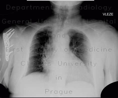 Radiology Case Deviation Of Trachea