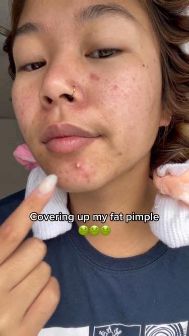 How To Cover While Pop Your Pimples Within A Day Skin Care Routine Pimples Skin Care Tips